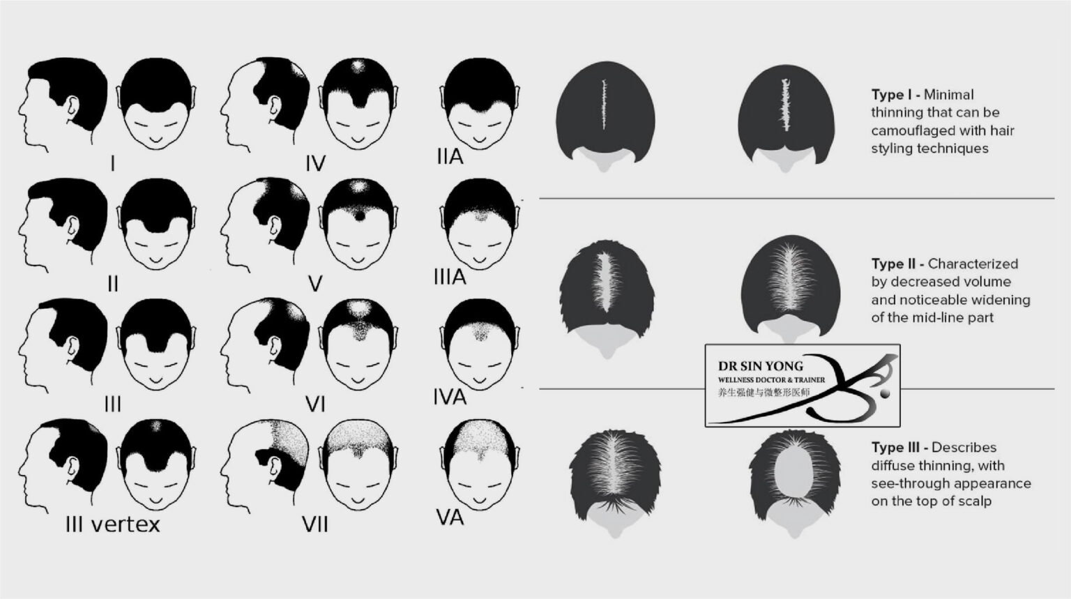 Anti Hair Loss Medications | Regenera Activa | Dr Sin Yong