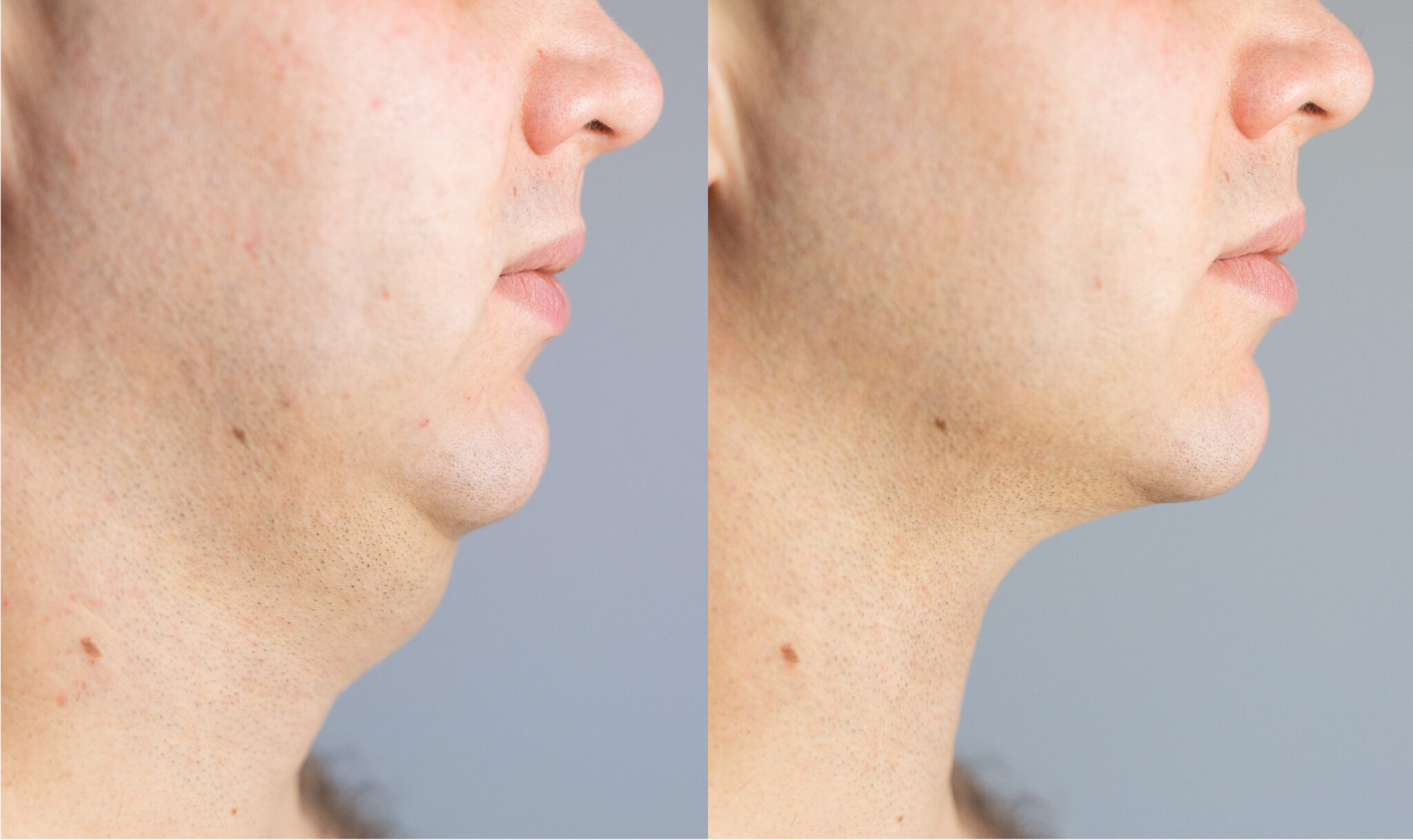 Chin Fillers | Enhance your chin & Jawline | Reduce double chin