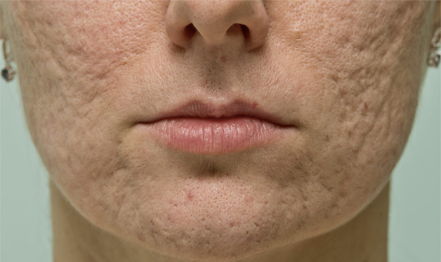 Scar Reconstruction: Treating Skin Scars | Dr Sin Yong