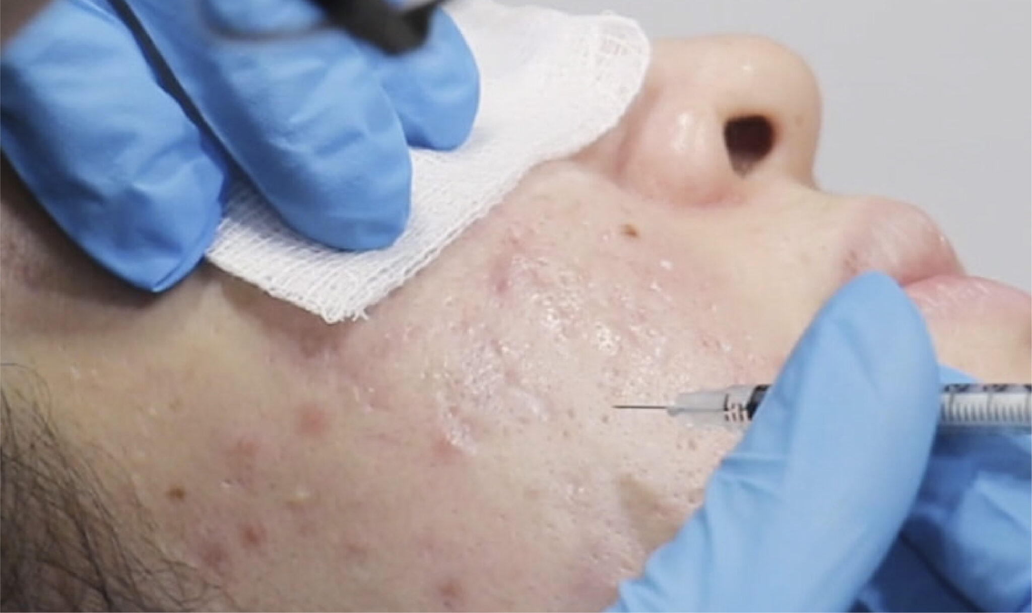 TCA Cross Treatment - Chemical Reconstruction Of Scar Surface