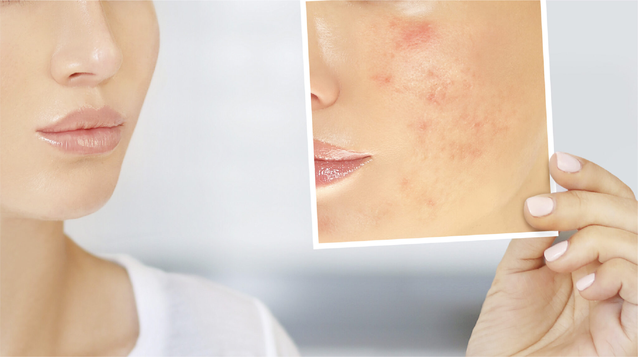 TCA Cross Treatment - Chemical Reconstruction Of Scar Surface