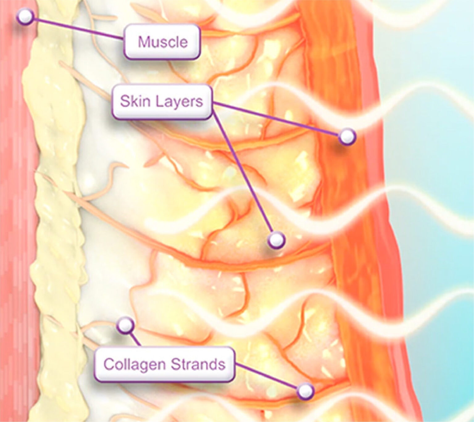 Thermage Treatment - Radiofrequency FaceLift | Dr Sin Yong