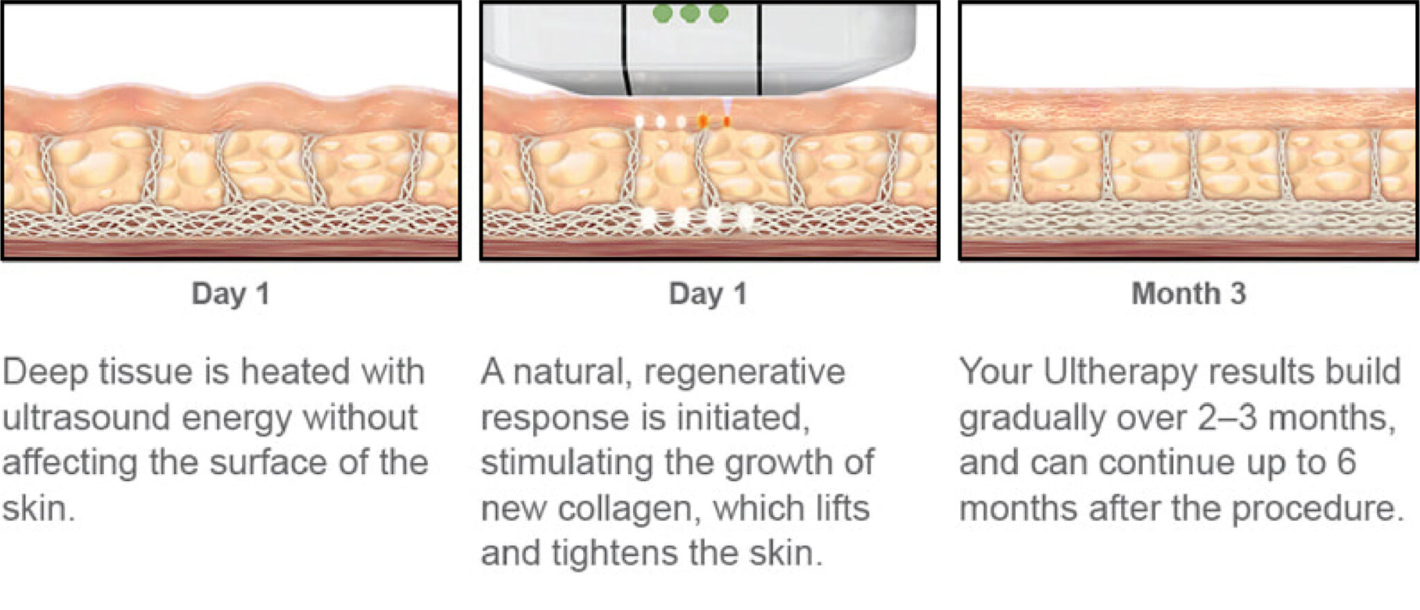 Ultherapy and HIFU Facelift treatments near me | Dr Sin Yong