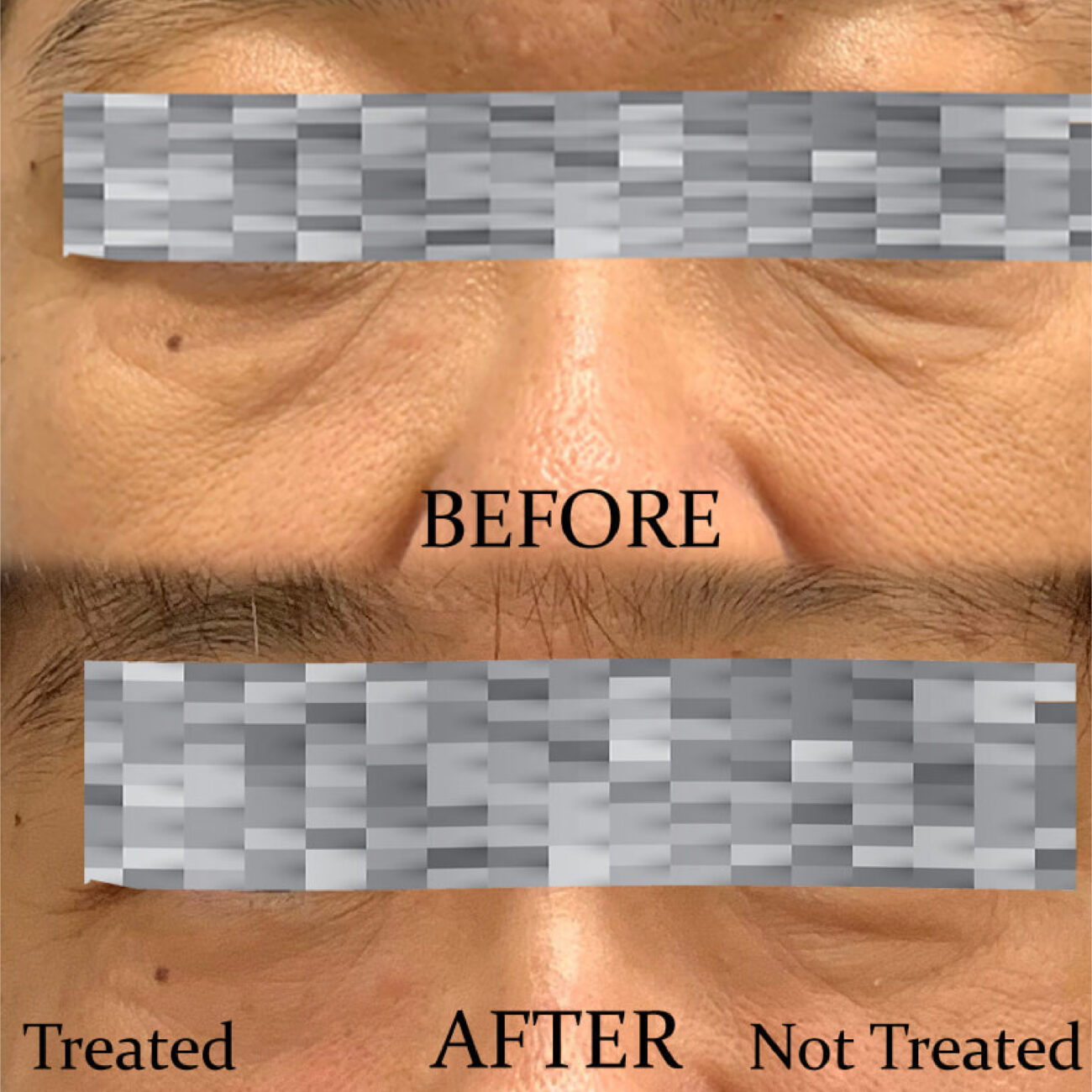 z lift treatment - Specific Localised Intensified Focal Transduction