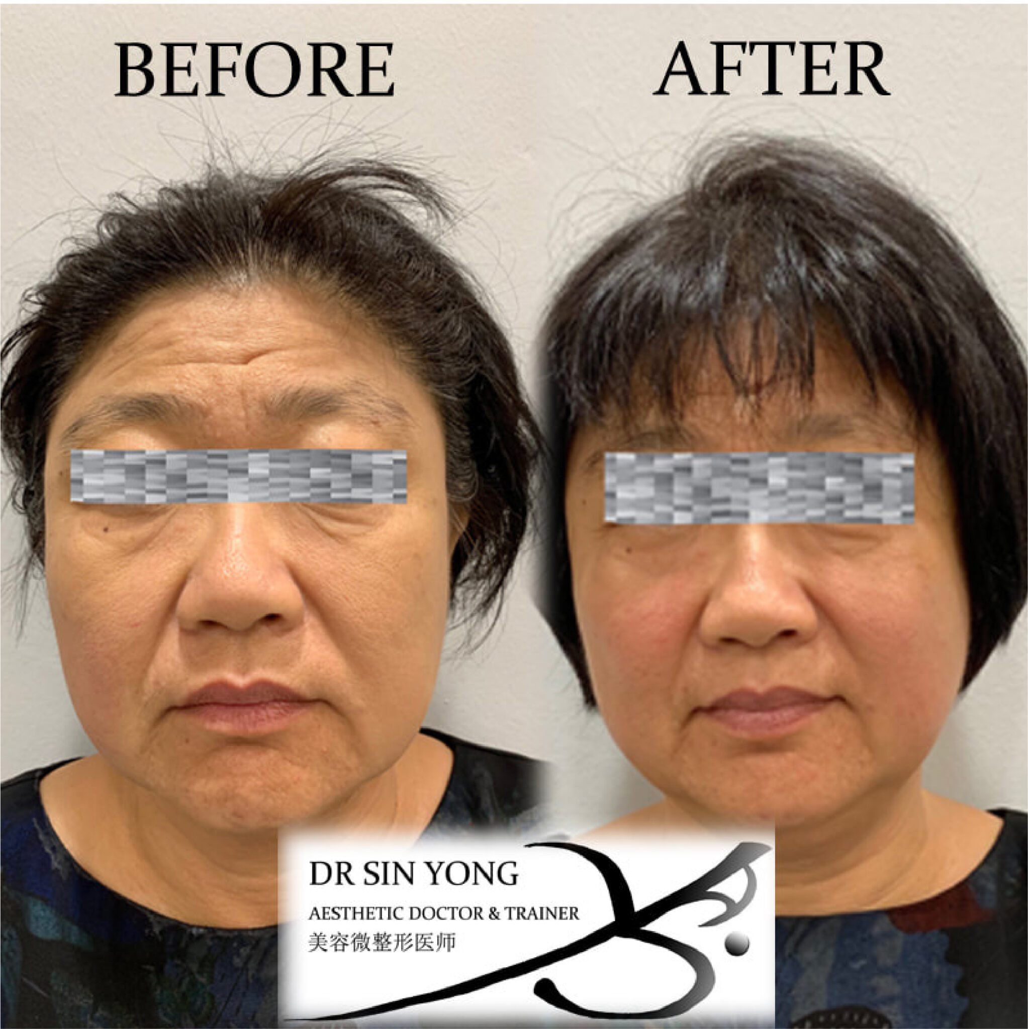 z lift treatment - Specific Localised Intensified Focal Transduction