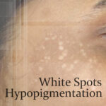White Spots Hypopigmentation Causes & Treatments | Dr Sin Yong